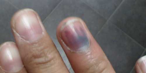 Jari Kejepit Pintu, Gak Usah Panik! - MalangVoice Jari Kejepit Pintu, Gak Usah Panik! - MalangVoice